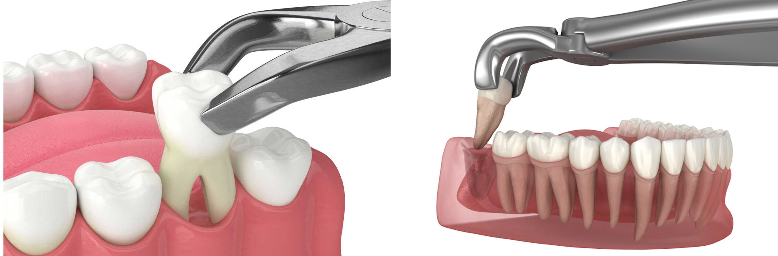 Regular Tooth Extraction vs Wisdom Tooth Extraction | Ashford Dental